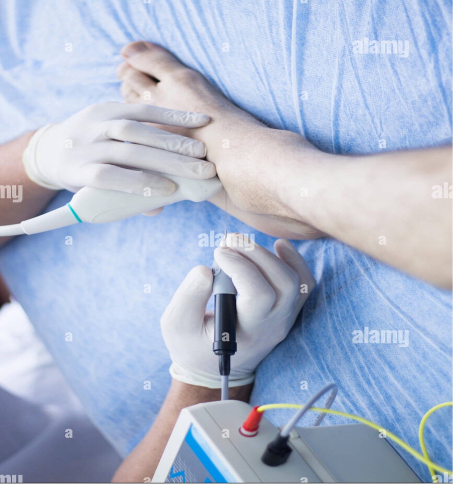 L'électrolyse percutanée intratissulaire (EPI®) — PhysioPod